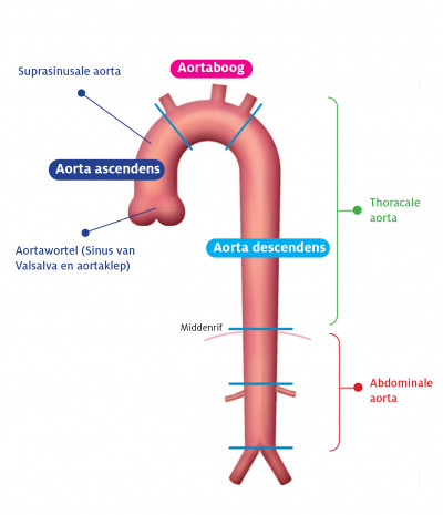 Ektatische Aorta Ascendens