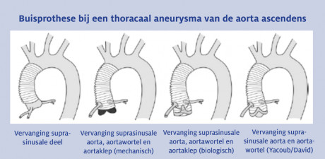 Thoracaal aorta aneurysma (TAA) | UZA